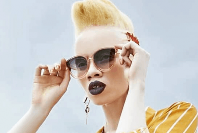 Albinism Archives | This is africa
